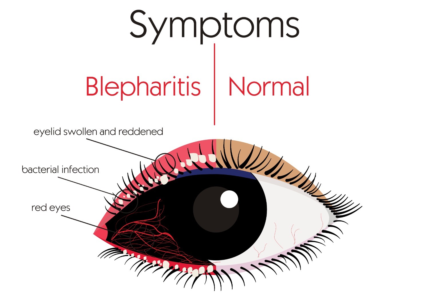 Eye Infections: Causes, Symptoms, and Treatment | Glasses2you